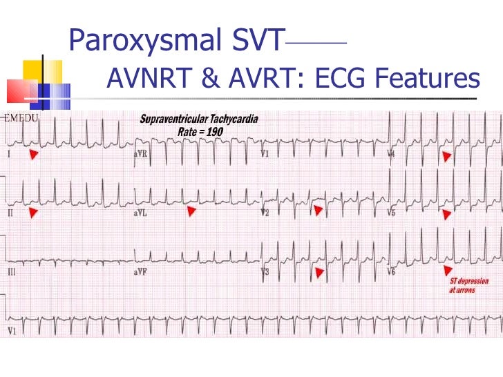16 arrhythmias2009