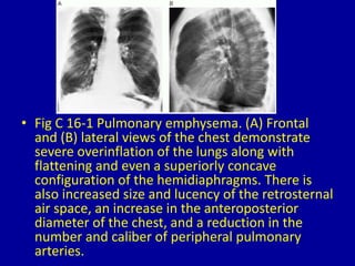 16 bilateral hyper lucent lungs | PPT