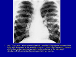 16 bilateral hyper lucent lungs | PPT