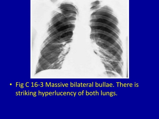 16 bilateral hyper lucent lungs | PPT
