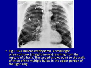 16 bilateral hyper lucent lungs | PPT