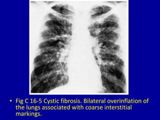 16 bilateral hyper lucent lungs | PPTX