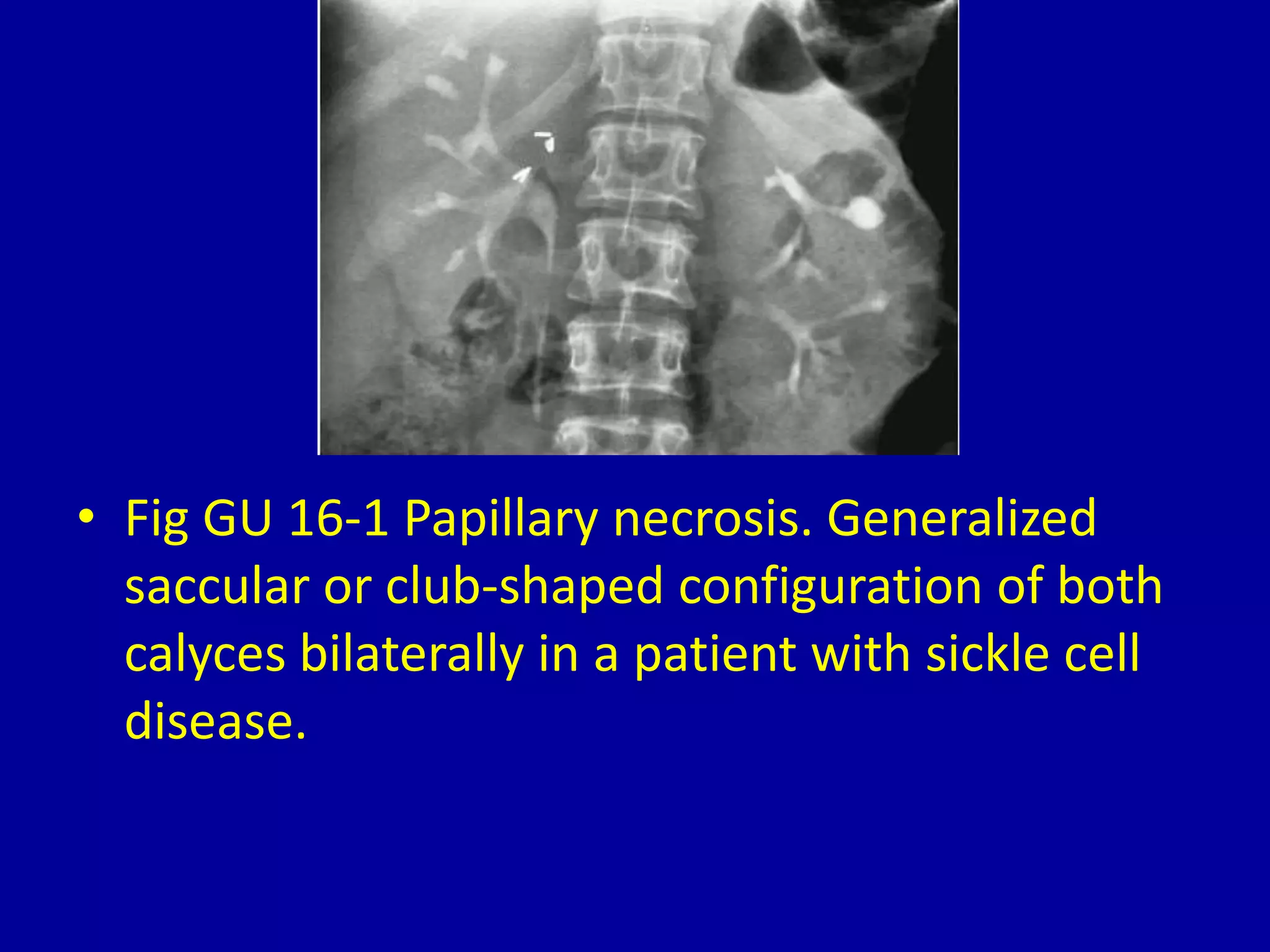 16 clubbing or destruction of renal calyces | PPTX