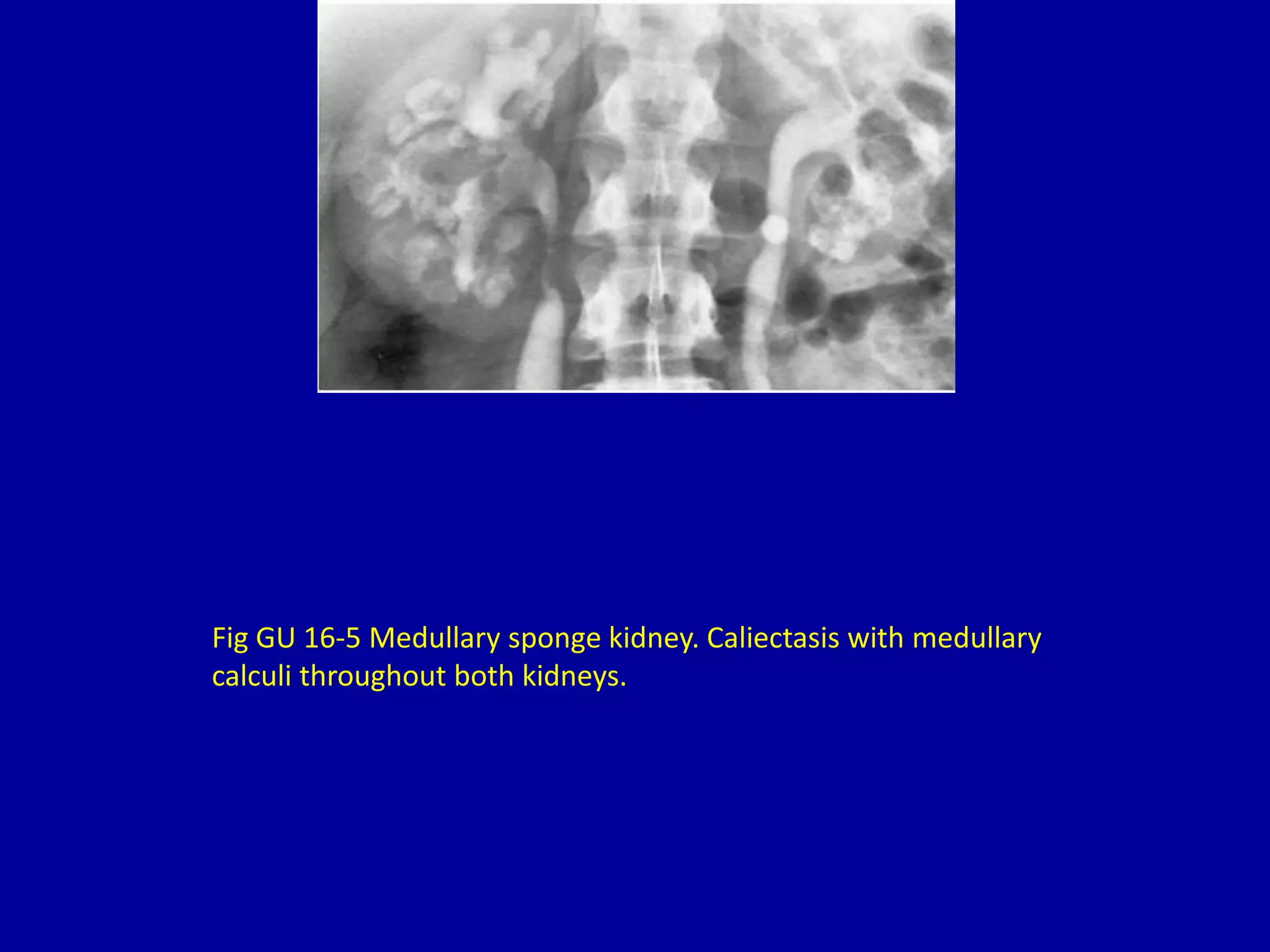 16 clubbing or destruction of renal calyces | PPTX