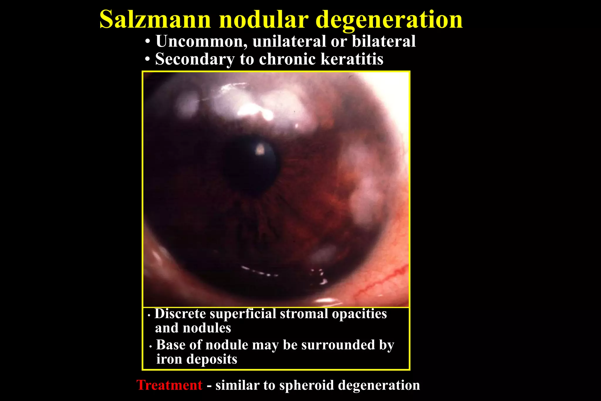 16Corneal Degenerations.ppt