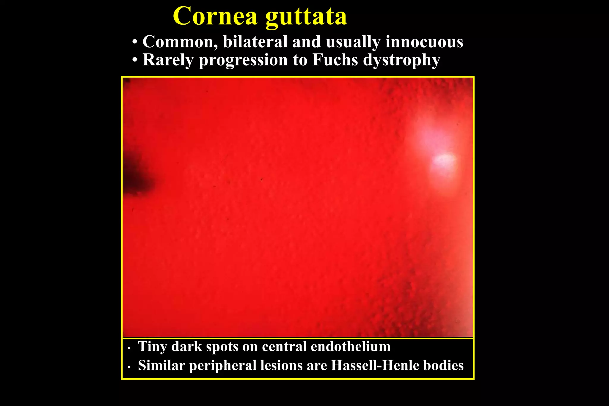 16Corneal Degenerations.ppt