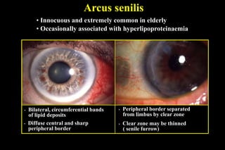 16Corneal Degenerations.ppt