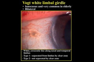16Corneal Degenerations.ppt