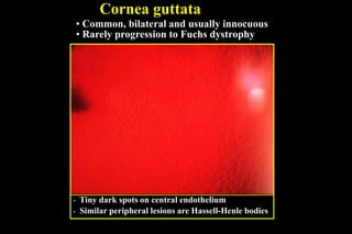 16Corneal Degenerations.ppt