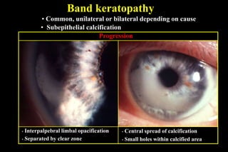 16Corneal Degenerations.ppt