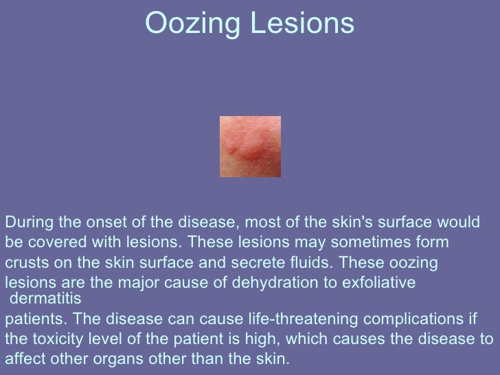 Unveiling The Facts About Exfoliative Dermatitis