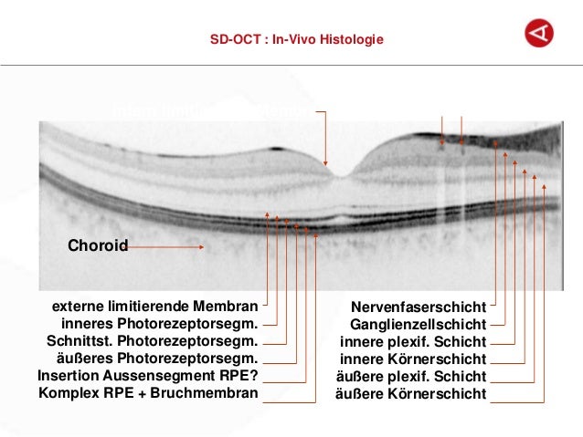 Die optische Kohärenztomographie (OCT Spectralis): Knifflige Befunde…