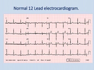 Interpretation of ECG lab session.ppt | Heart and Cardiovascular ...