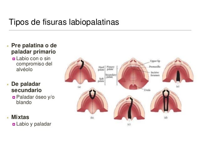 UVM Clinica Medica Integral Sesion 16 Labio y Paladar Hendidos
