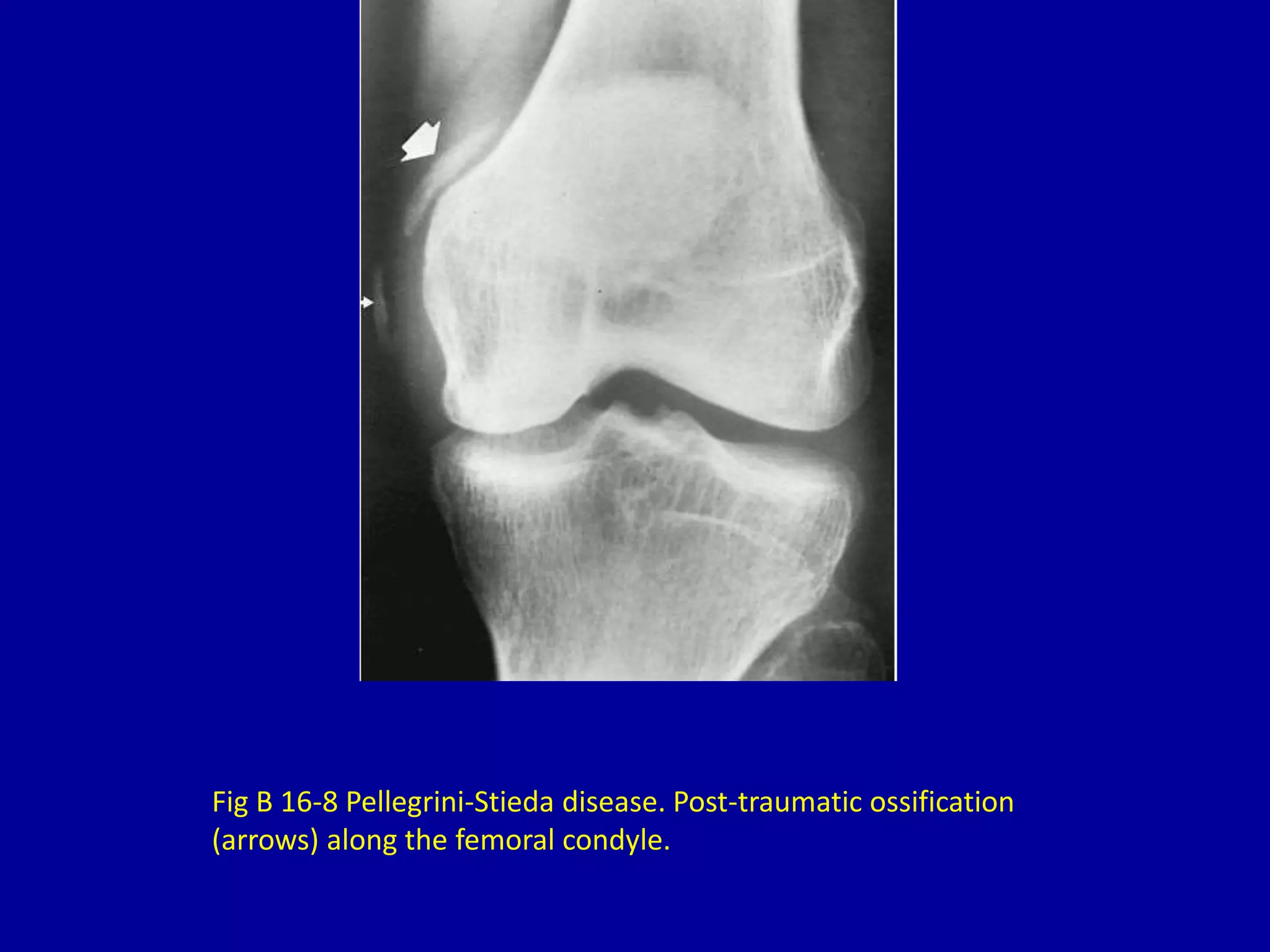16 periarticular calcification | PPTX