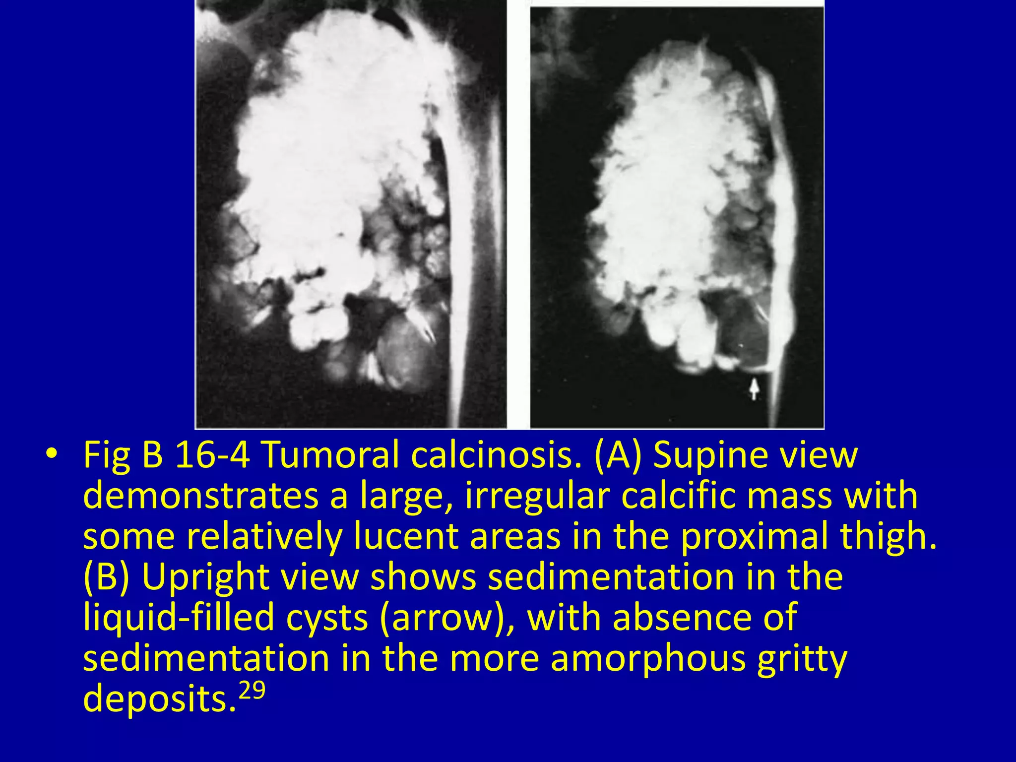 16 periarticular calcification | PPTX
