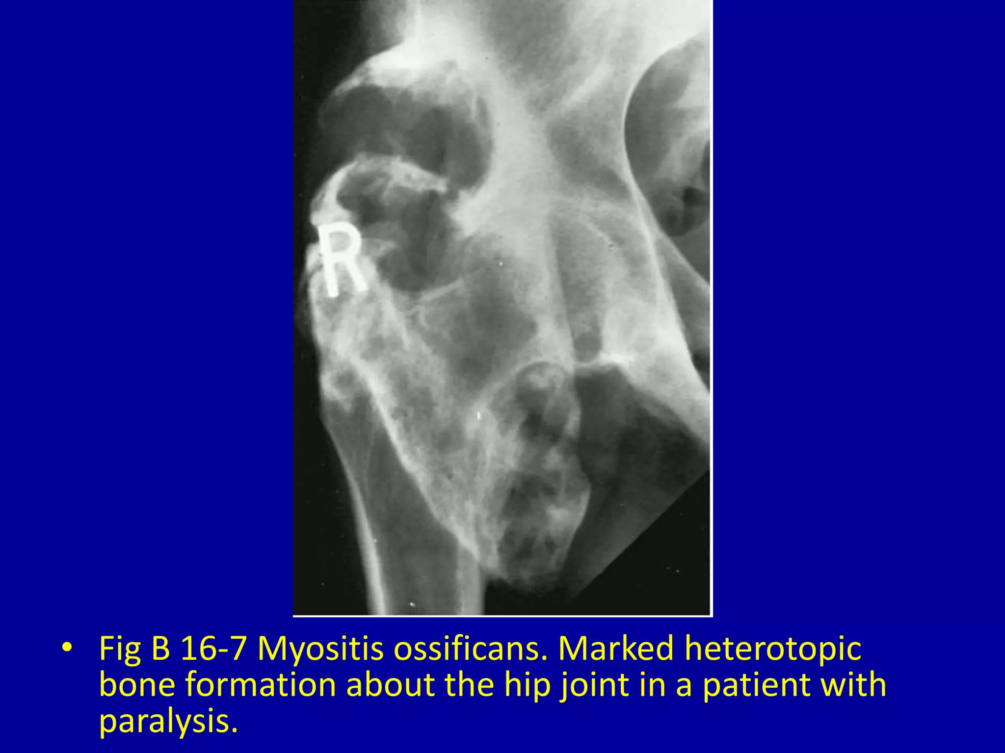 16 periarticular calcification | PPTX