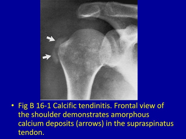 16 periarticular calcification | PPT