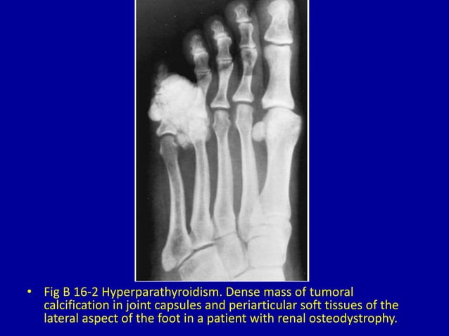 16 periarticular calcification | PPT