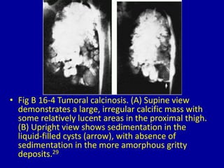16 periarticular calcification | PPTX