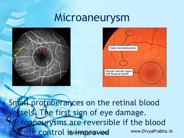 Diabetic Retinopathy