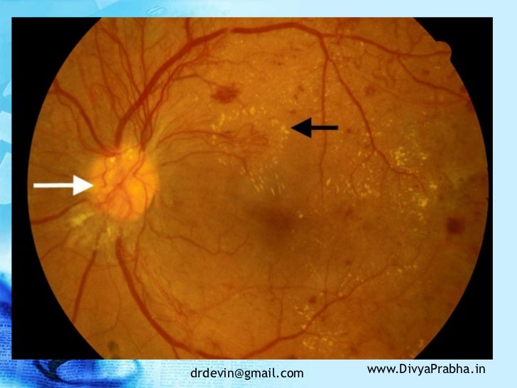 Diabetic Retinopathy