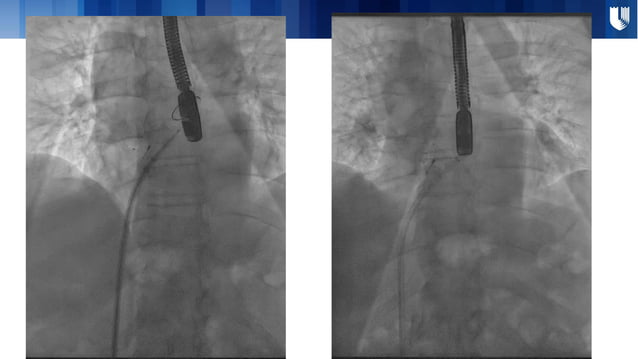 Update on Percutaneous Left Atrial Appendage Occlusion | PPT