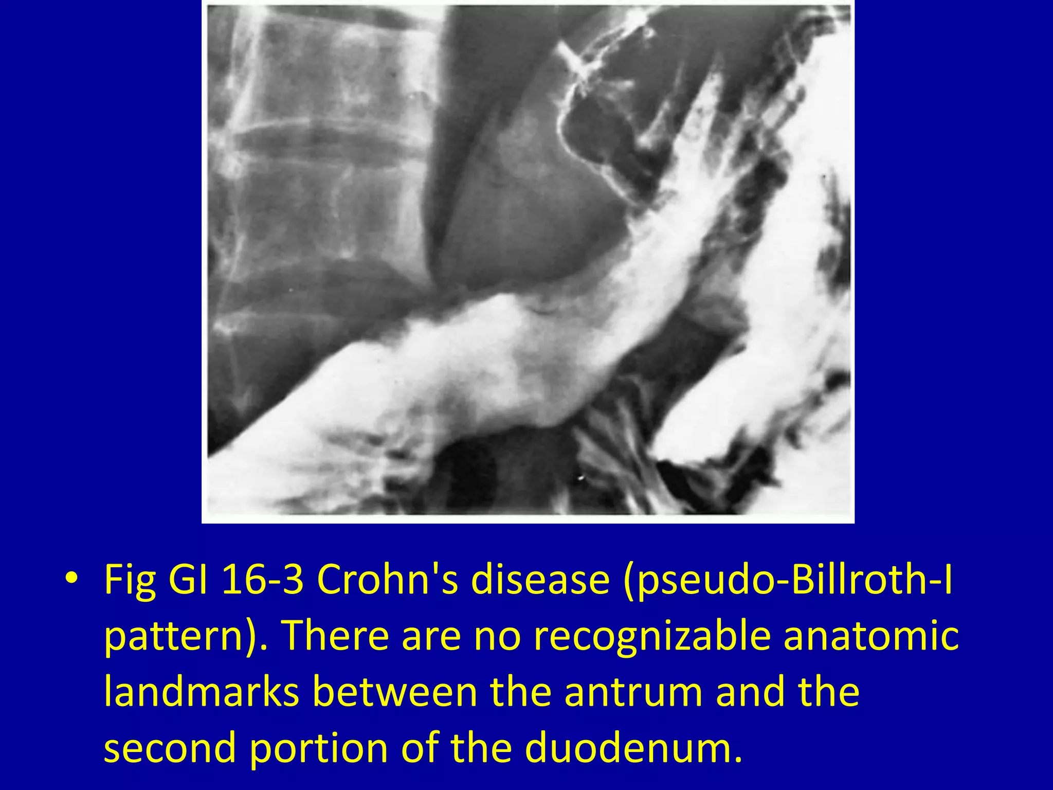 16 simultaneous involvement of the gastric antrum and | PPTX