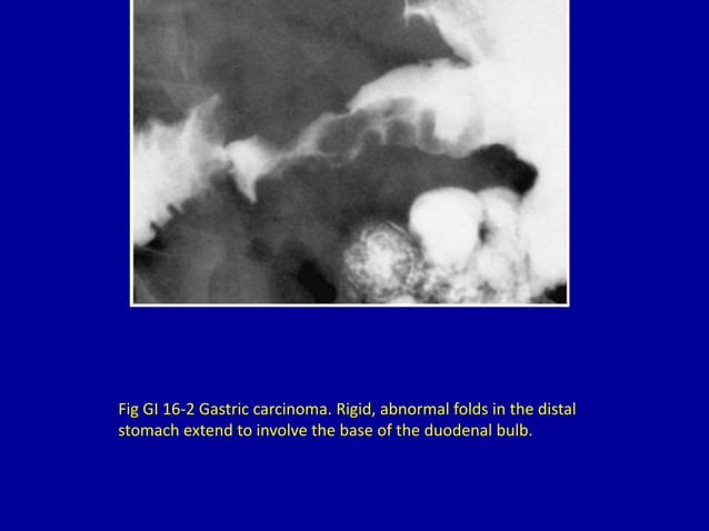 16 simultaneous involvement of the gastric antrum and | PPT