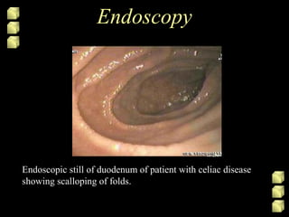 celiac disease | PPT