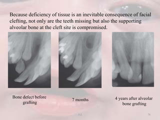role of orthodontist in Cleft lip and palate management | PPTX