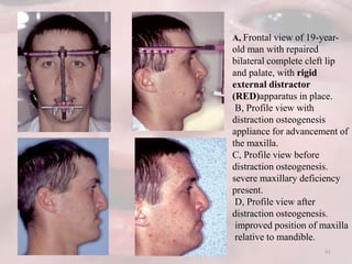 role of orthodontist in Cleft lip and palate management | PPTX