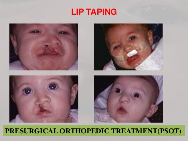 role of orthodontist in Cleft lip and palate management