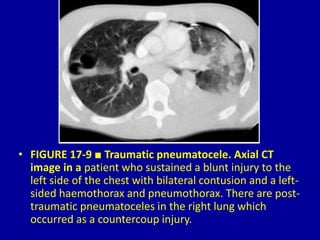 17 Thoracic Trauma and Related Topics | PPTX