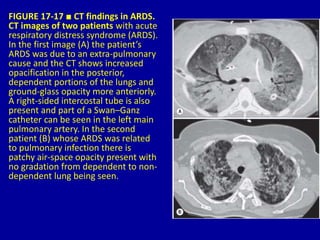 17 Thoracic Trauma and Related Topics | PPTX