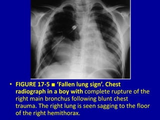 17 Thoracic Trauma and Related Topics | PPTX