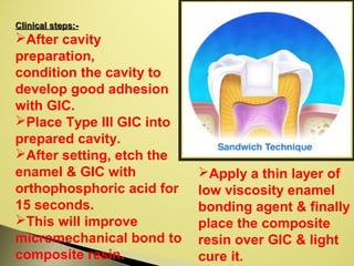 Glass Ionomer Cement PPT