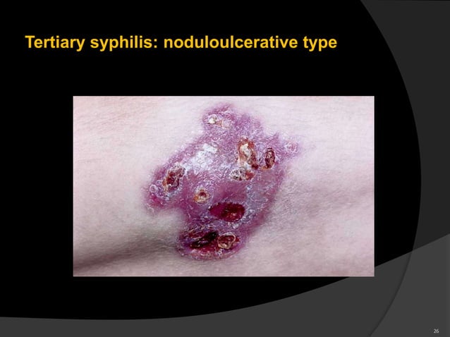17. Syphilis | PPT