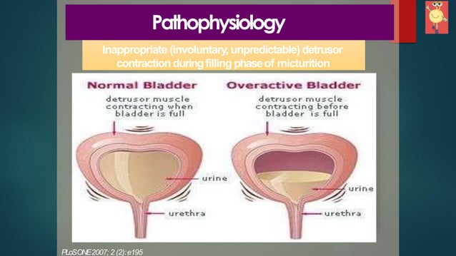 All you need to know about Overactive Bladder Disease | PPT