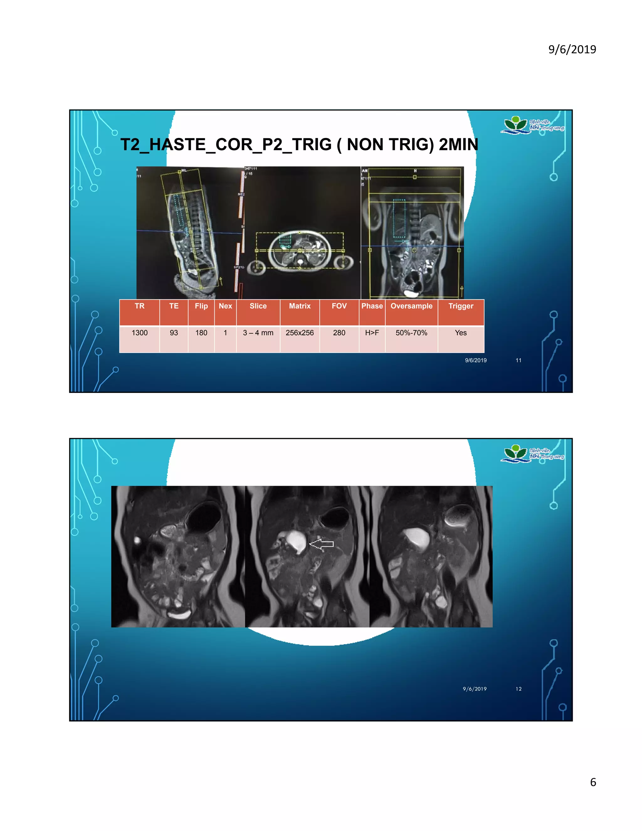 Ky thuat chup va hinh anh MRCP u nang ong mat chu o tre em tren may ...