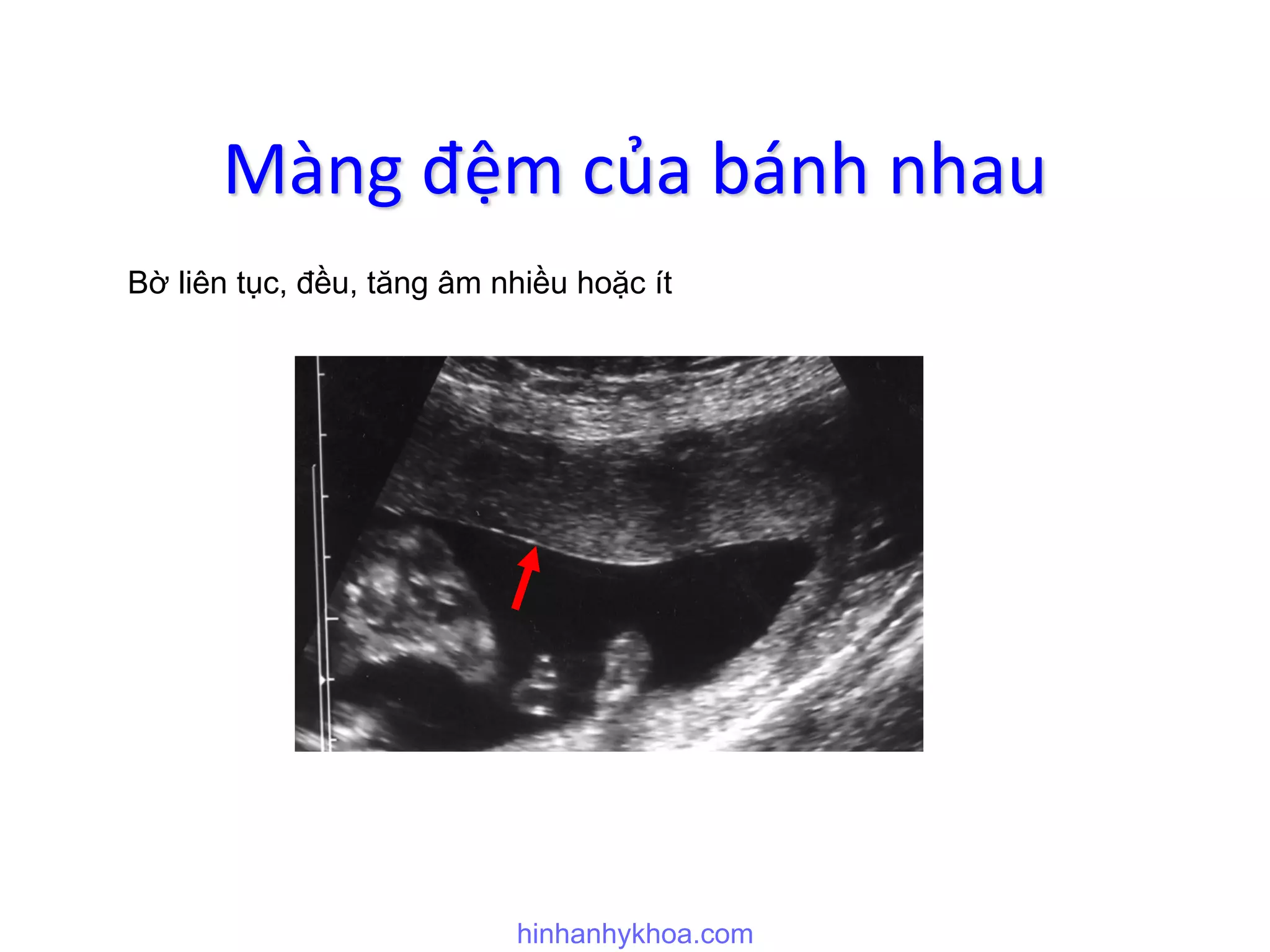 17. Sieu am banh nhau, GS Michel Collet | PDF