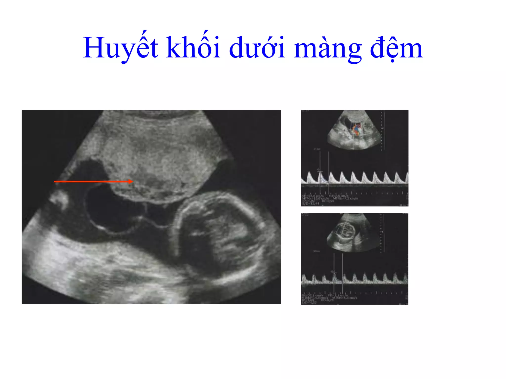 17. Sieu am banh nhau, GS Michel Collet | PDF