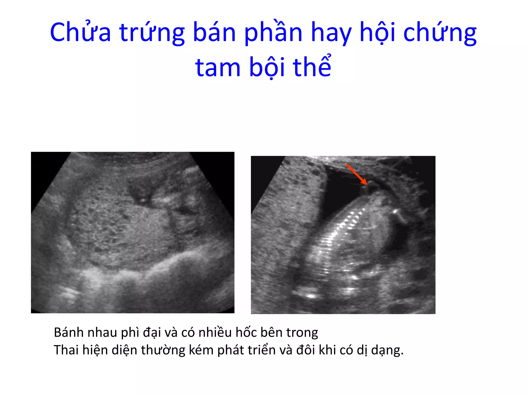 17. Sieu am banh nhau, GS Michel Collet | PDF