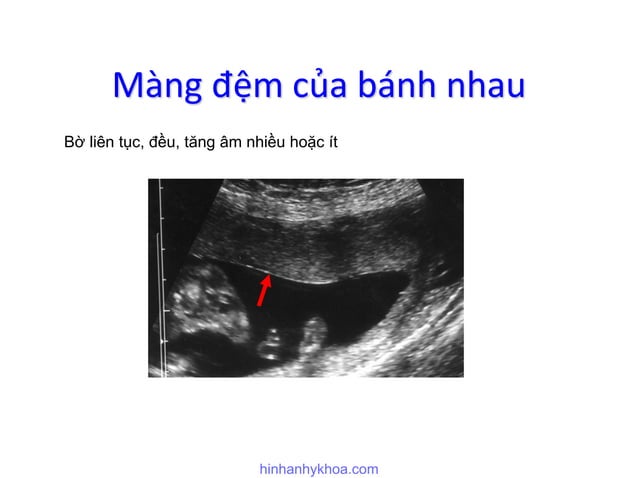 17. Sieu am banh nhau, GS Michel Collet | PDF