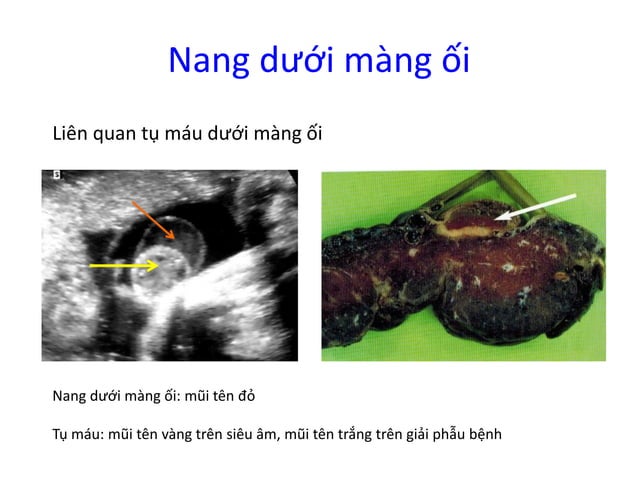 17. Sieu am banh nhau, GS Michel Collet | PDF