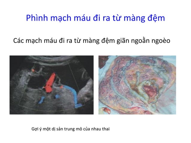 17. Sieu am banh nhau, GS Michel Collet | PDF