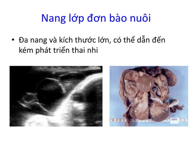 17. Sieu am banh nhau, GS Michel Collet | PDF
