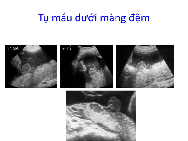 17. Sieu am banh nhau, GS Michel Collet | PDF