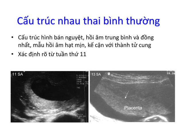 17. Sieu am banh nhau, GS Michel Collet | PDF