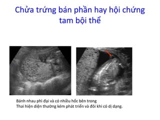 17. Sieu am banh nhau, GS Michel Collet | PDF